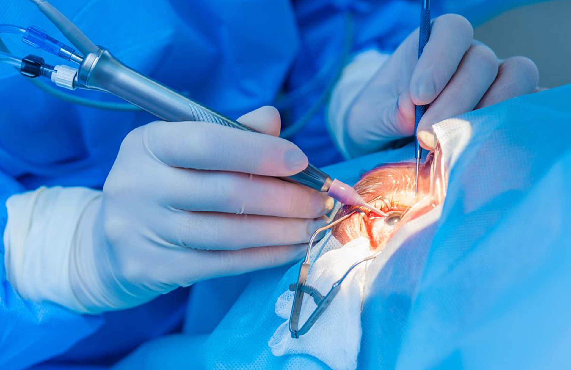 Cirugía de Catarata en Guayaquil - Centro Oftálmico Gaibor